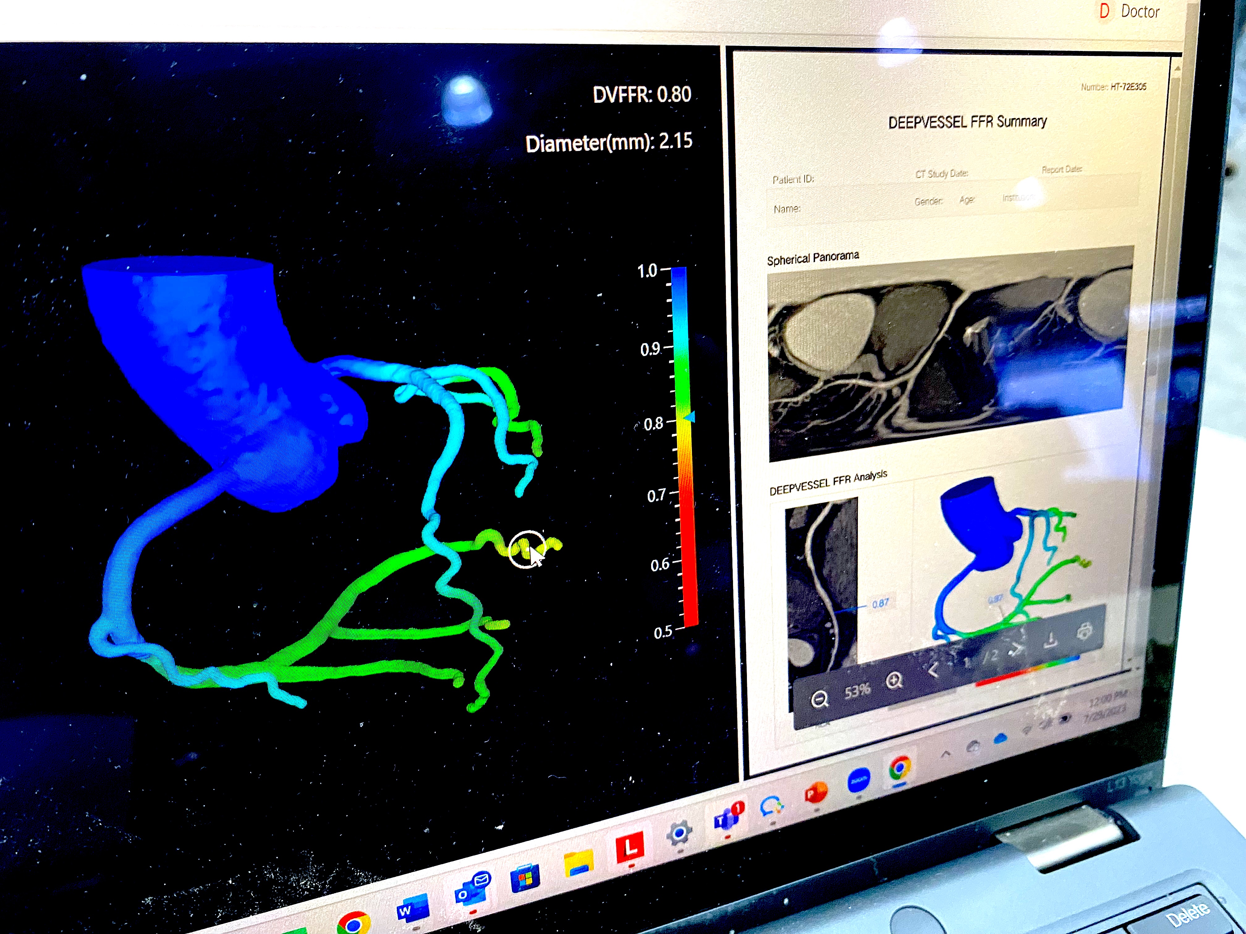 Reimbursement expected to drive implementation of CCTA, coronary plaque ...