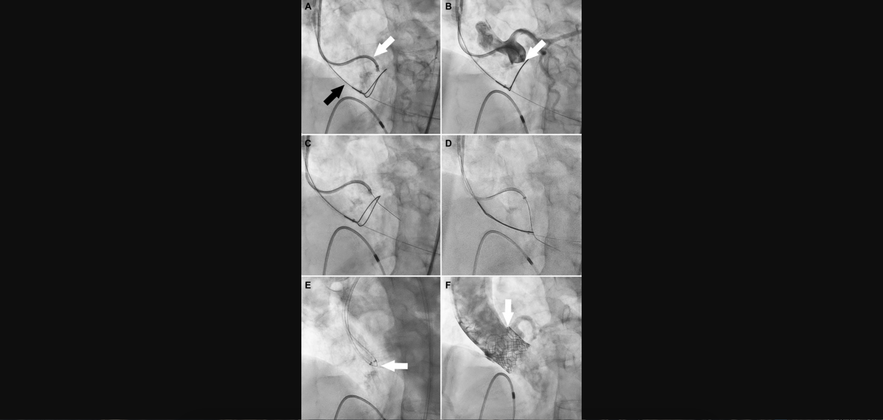 FDA clears TAVR guidewire built with BASILICA in mind