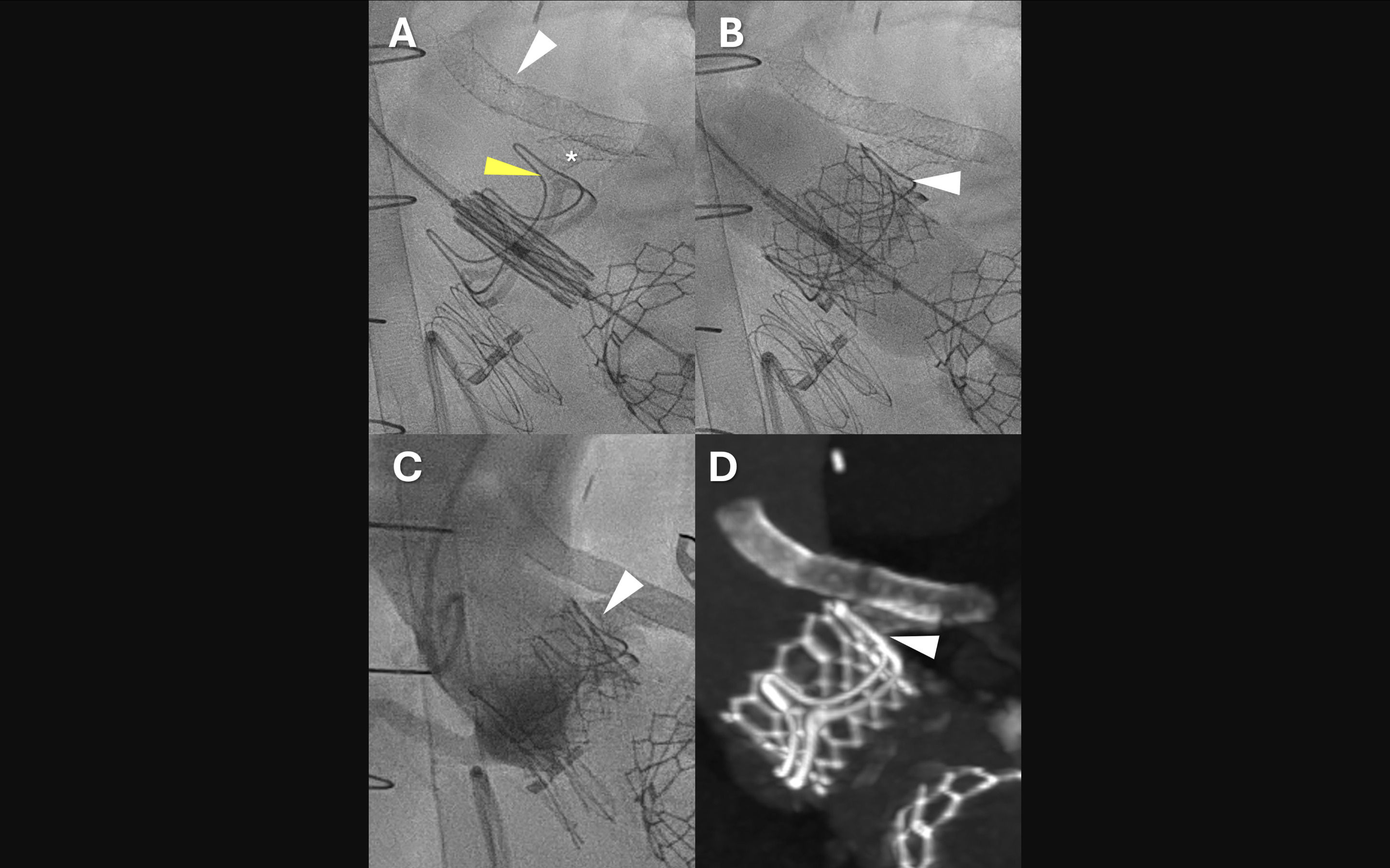 Cardiologists perform first procedure of its kind to prevent coronary ...