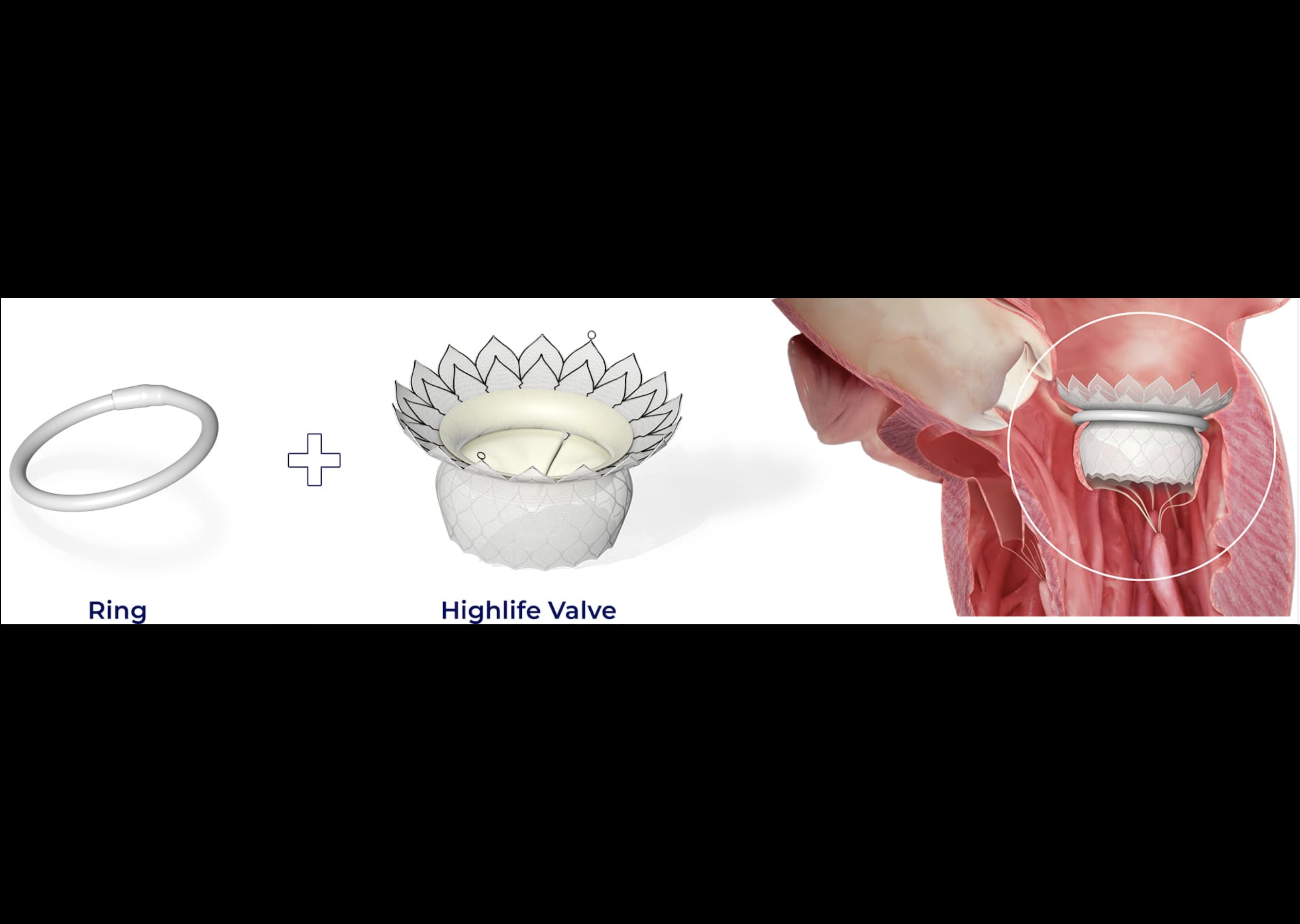 TMVR device with valve-in-ring design gains key approval