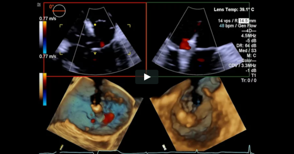 3D TEE: How Is the Technology Transforming?