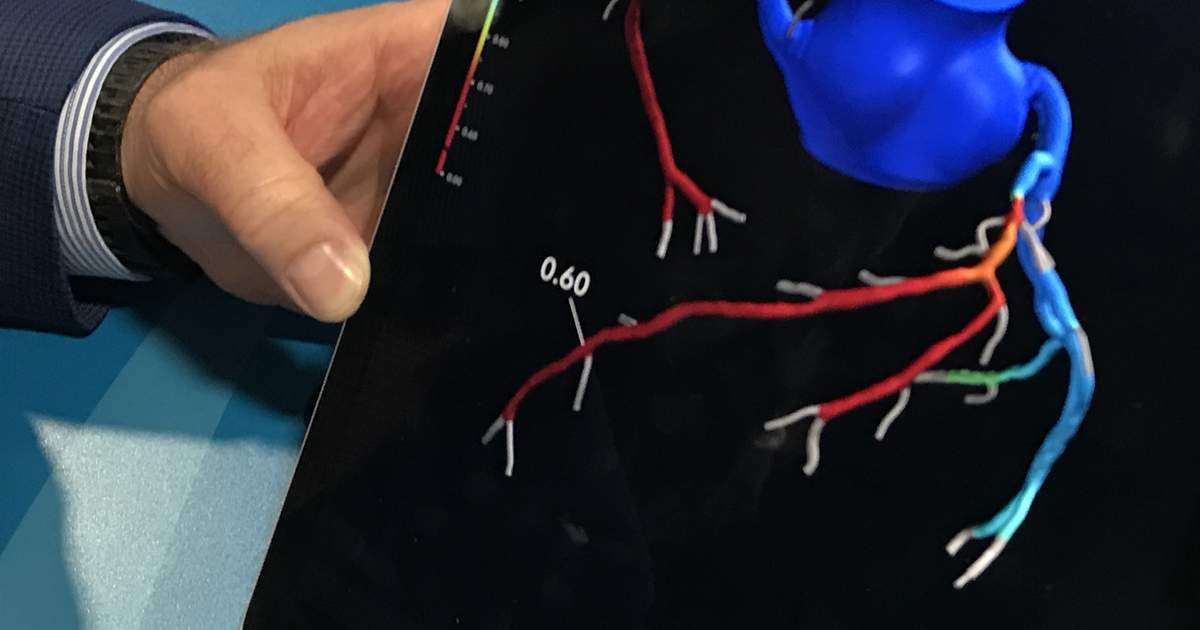 HeartFlow’s AI-powered CAD offering receives new CPT code with improved ...