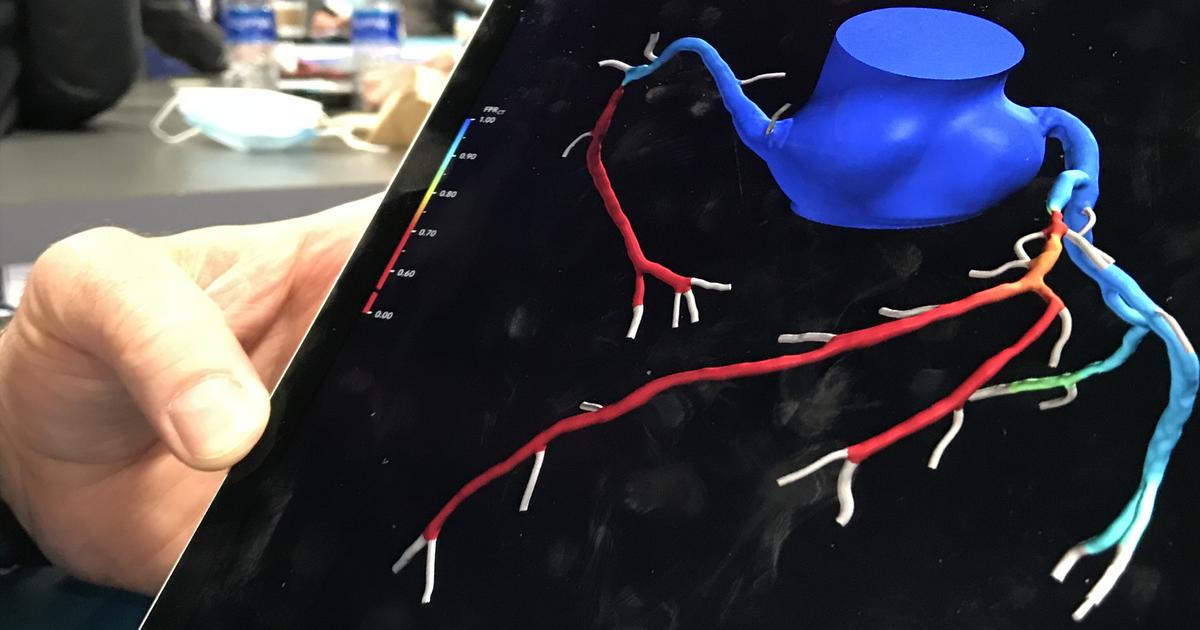 HeartFlow raises $215M to keep up with growing demand