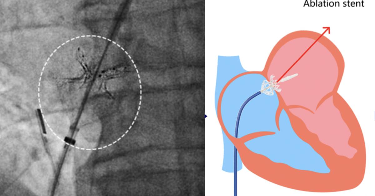 Researchers share first human data on new interventional shunt ...