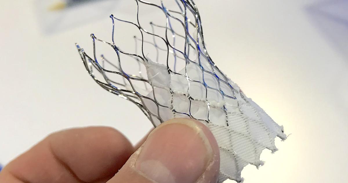 Redo TAVR appears feasible for most patients with supra-annular, self ...