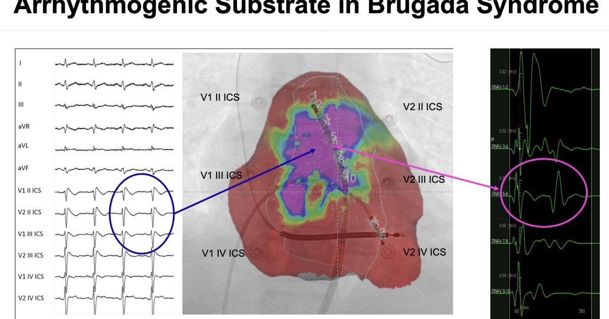 Epicardial ablation in Brugada syndrome reduces sudden cardiac death