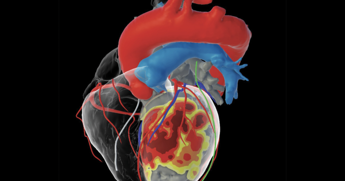 3D cardiac modeling solution for VT ablation receives FDA clearance