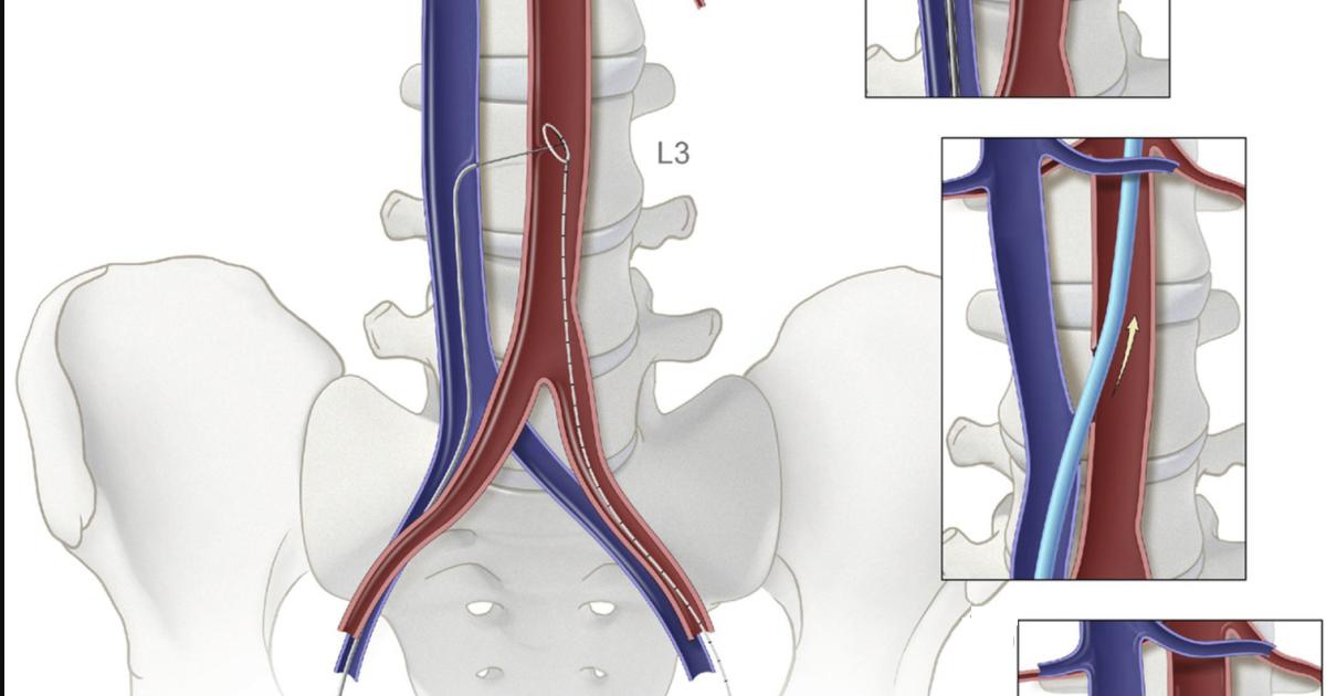 Transcaval TAVR outperforms transaxillary TAVR when femoral access is ...