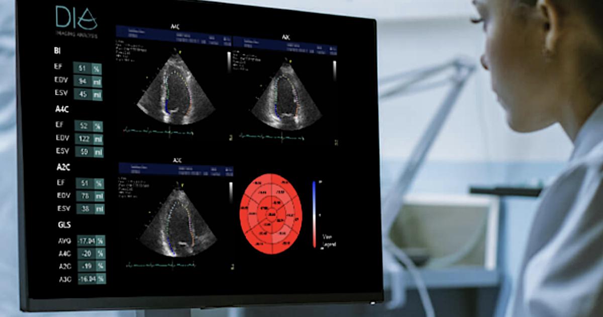 ScImage latest vendor to adopt DiA Imaging Analysis AI for echocardiography