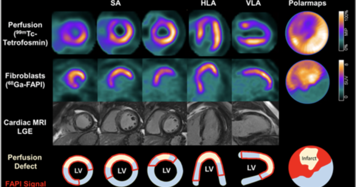 FAPI PET shows promise to make a big impact in cardiovascular imaging