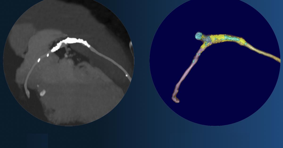 Cardiac CT soft plaque assessment may offer paradigm shift for coronary ...