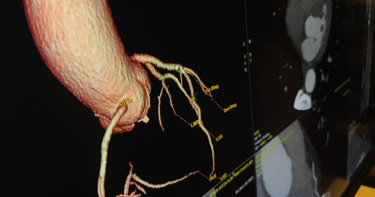 VIDEO: CT imaging to plan coronary interventions — Interview with ...