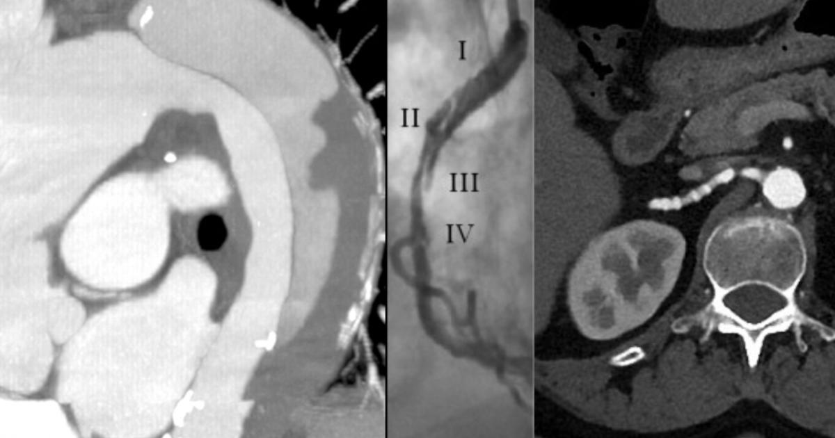 VIDEO: Vascular imaging applications for CT beyond the heart