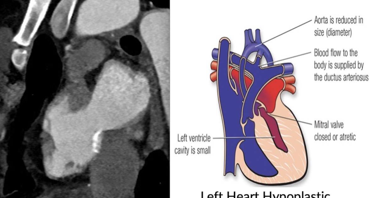 VIDEO: Congenital heart imaging with cardiac CT