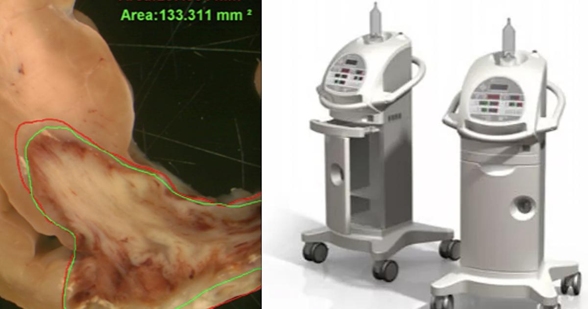 FDA approves trial for new type of thermal-ablation system to treat ...