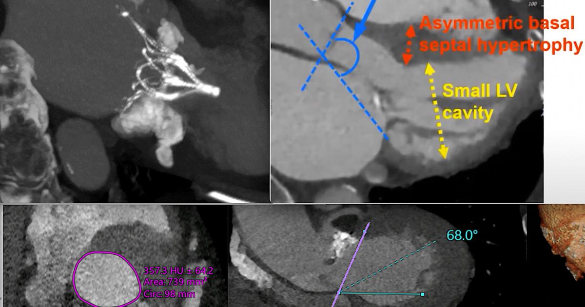 VIDEO: CT imaging for TAVR and TMVR structural heart interventions