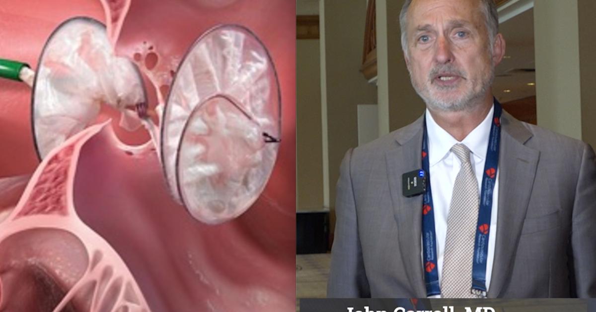 VIDEO: Role of PFO closure in stroke prevention