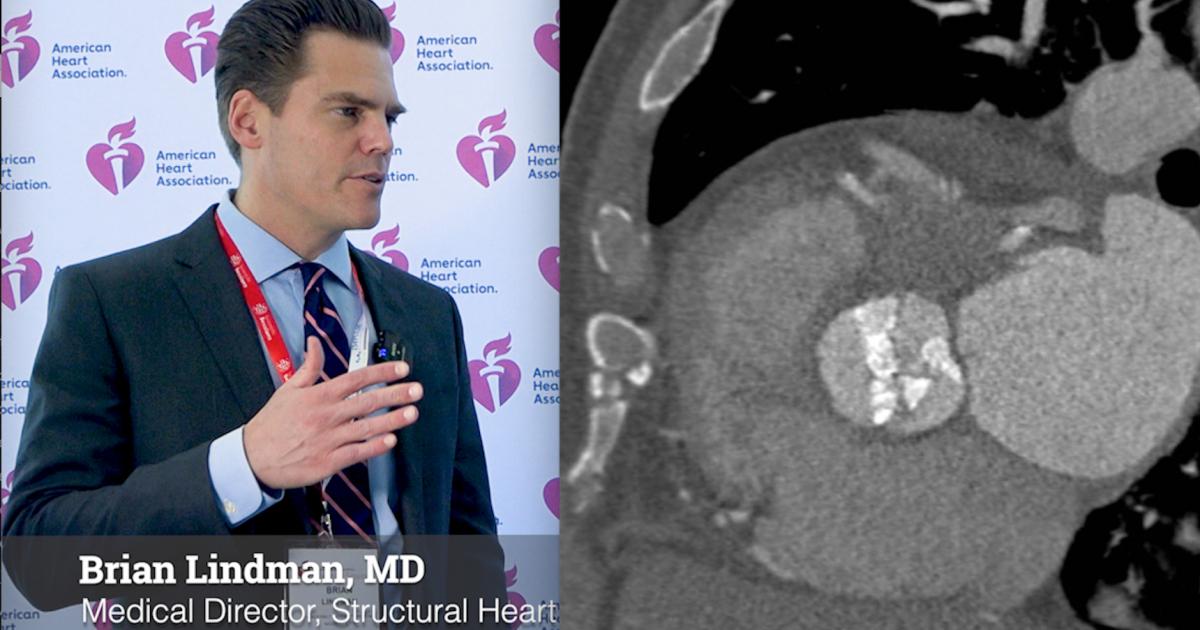 VIDEO: AHA says aortic stenosis is undertreated and underdiagnosed