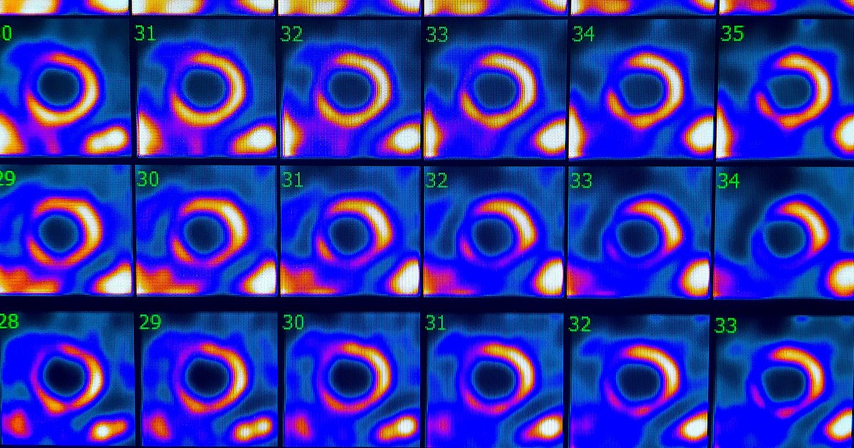 Global shortage of nuclear imaging isotopes may be over