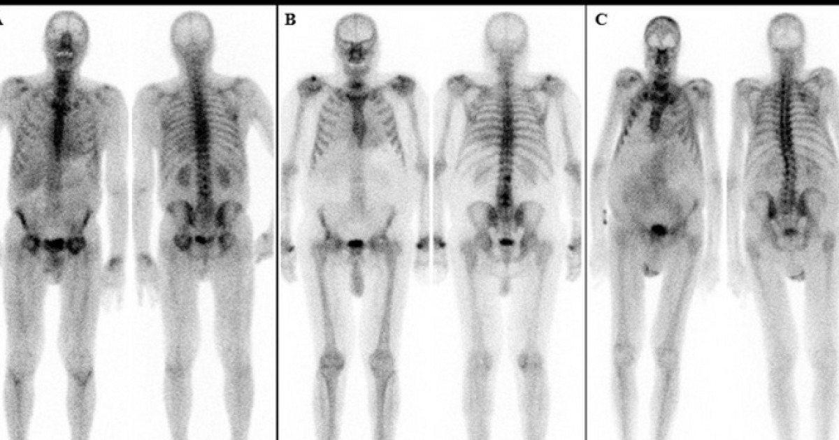 ASNC reports shortage of cardiac amyloidosis radiotracers