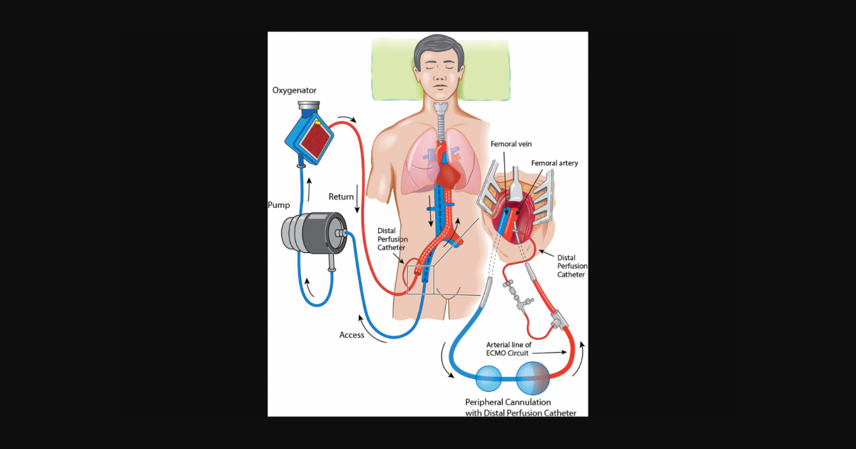 Extracorporeal CPR for out-of-hospital cardiac arrest: New research ...