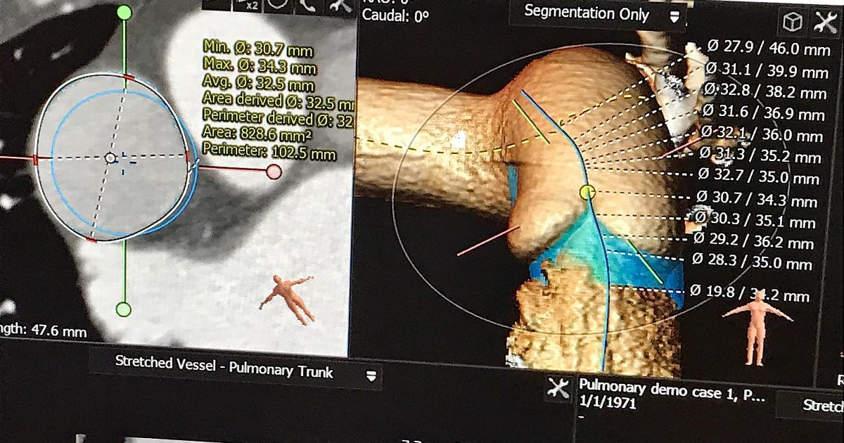 FDA makes clearance easier for cardiac device implant simulation software