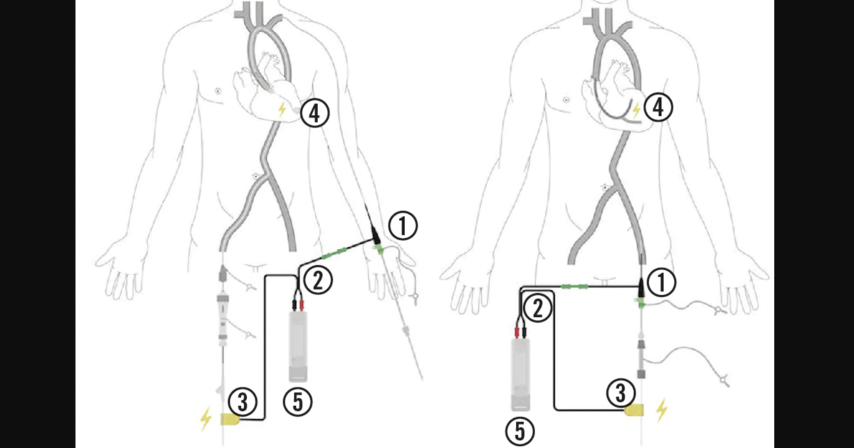 New direct wire pacing device shows potential during PCI and TAVR ...