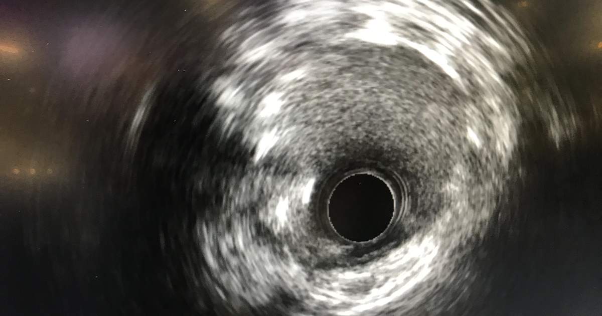 IVUS-guided PCI boosts 2-year survival, reduces need for bypass surgery