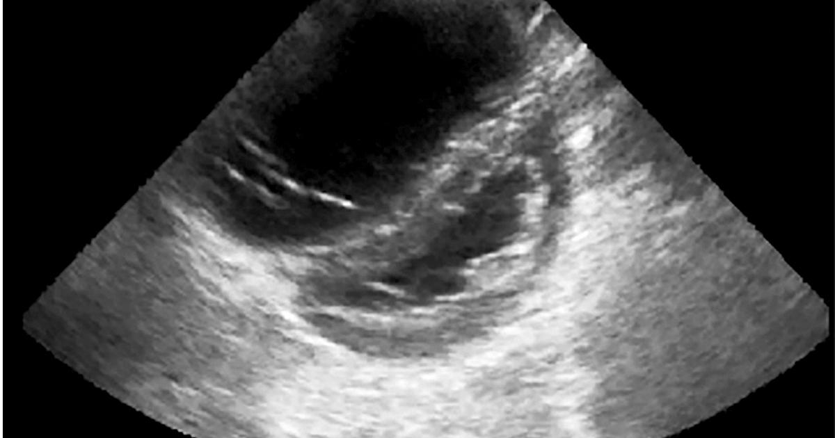 New ASE guidance examines cardiac POCUS in children