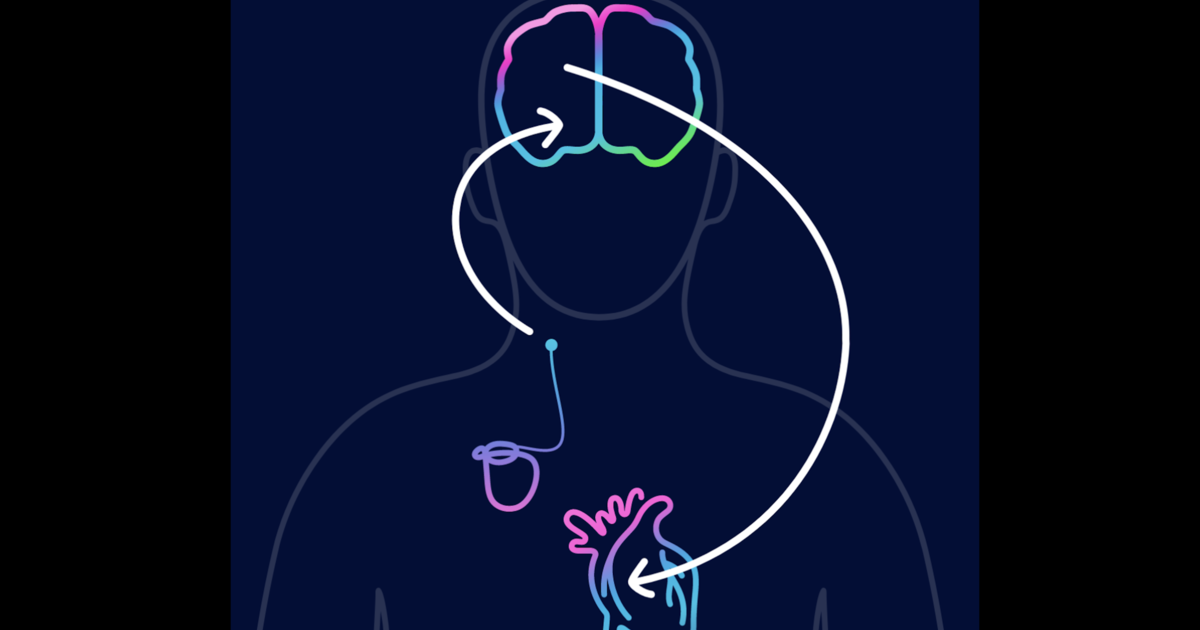 CMS increases inpatient payment for implantable Barostim device