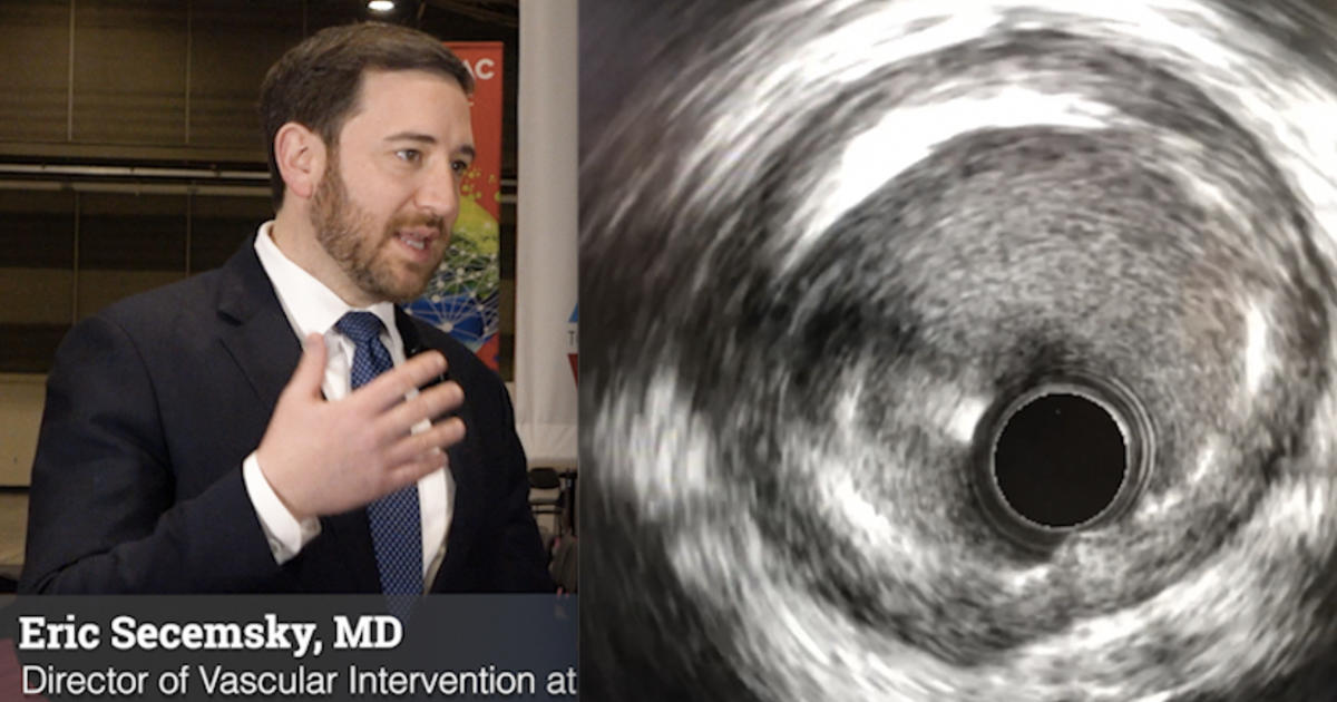 Intravascular imaging-guided PCI boosts outcomes, but utilization ...