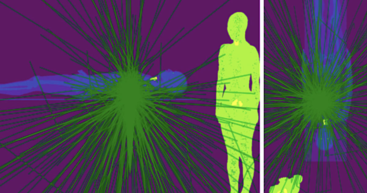 Radiation exposure in the cath lab: Tracking the impact on ...
