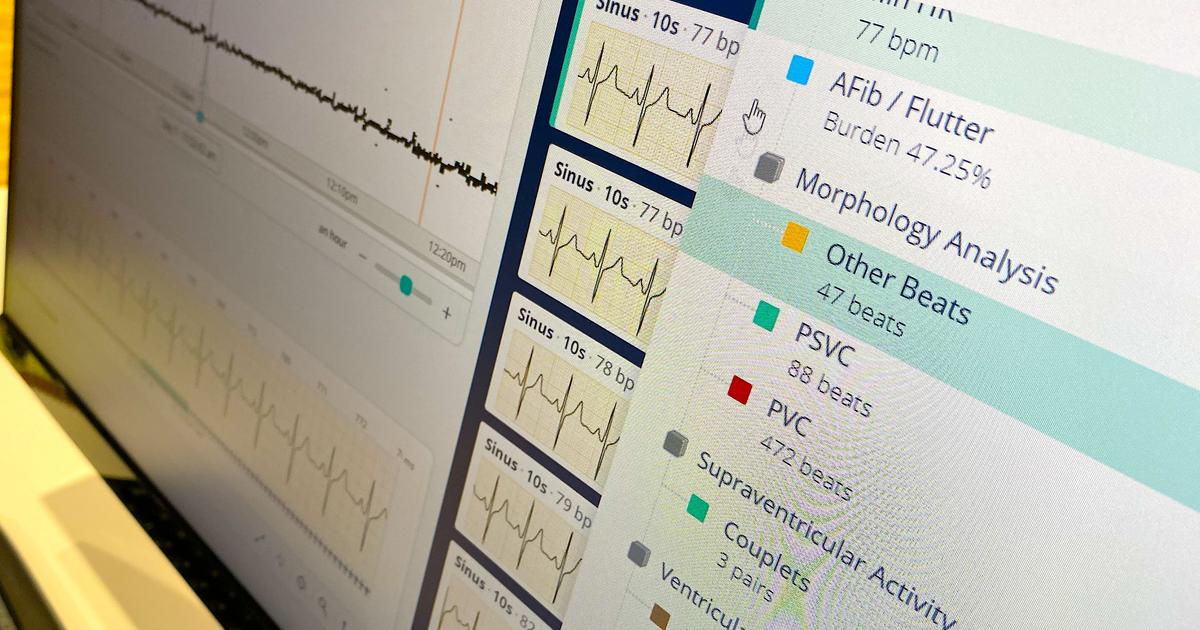 AI correctly IDs ventricular arrhythmias in 88% of patients with ...