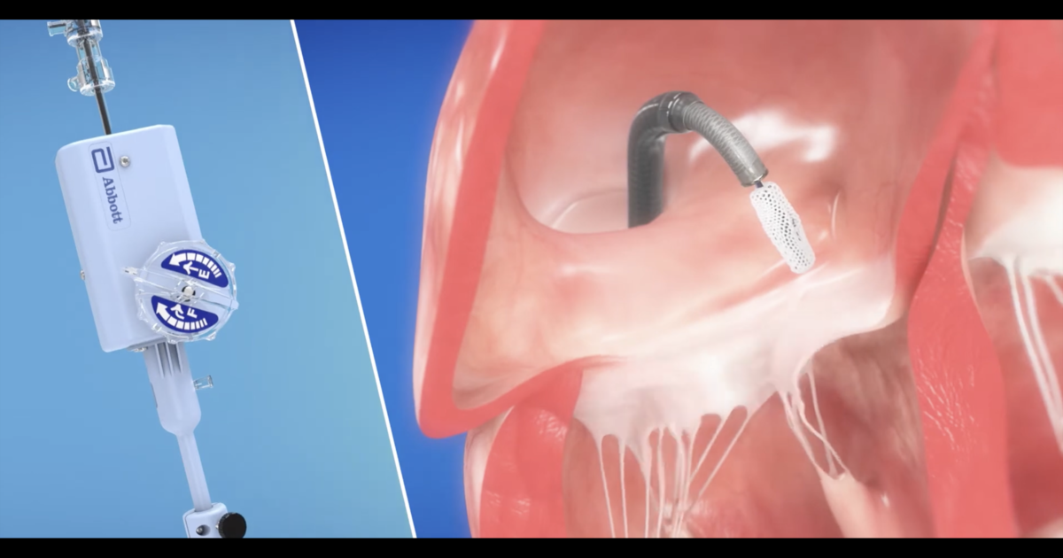 TriClip triumphs: Tricuspid edge-to-edge repair linked to strong 30-day ...
