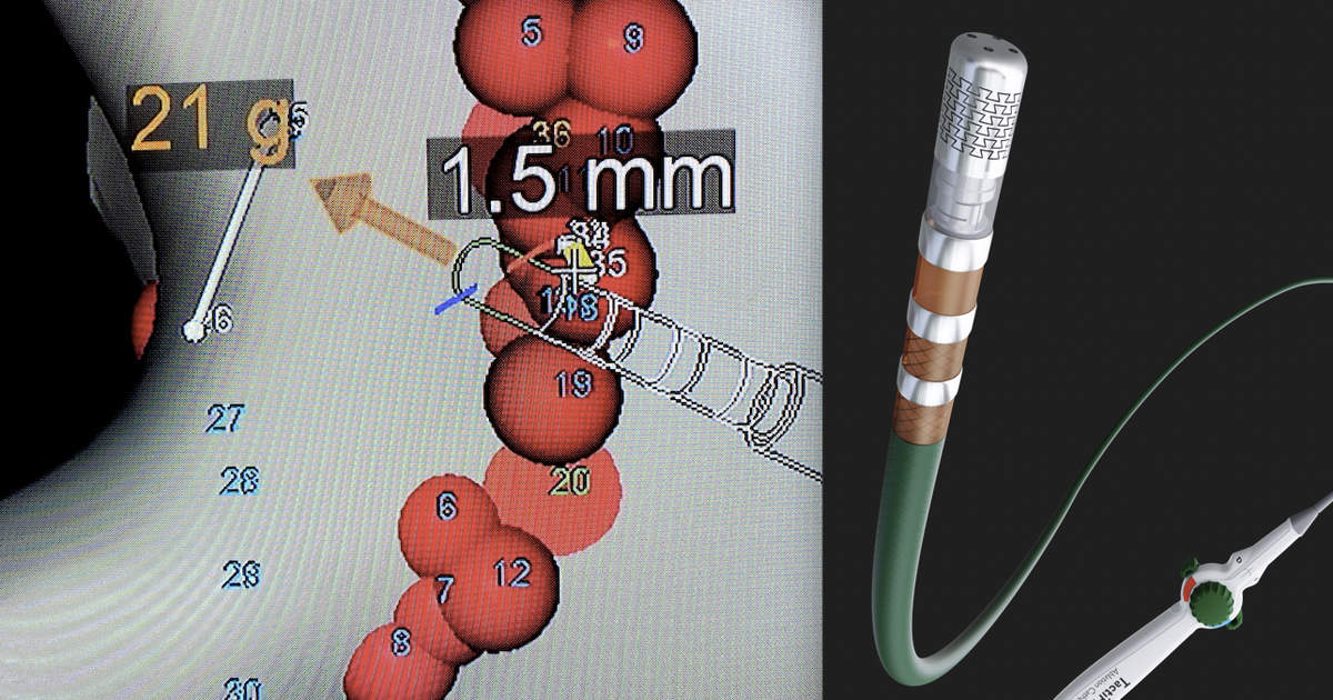 Fda Clears First Ablation Catheter With Flexible Electrode Tip Contact Force Sensing