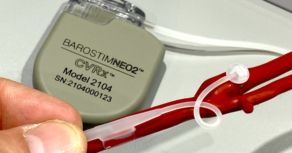 Implantable Barostim device improves long-term heart failure symptoms