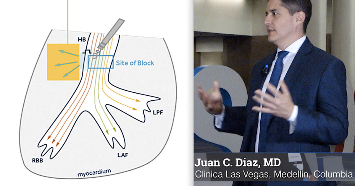 Left bundle branch pacing: A successful alternative to standard lead ...