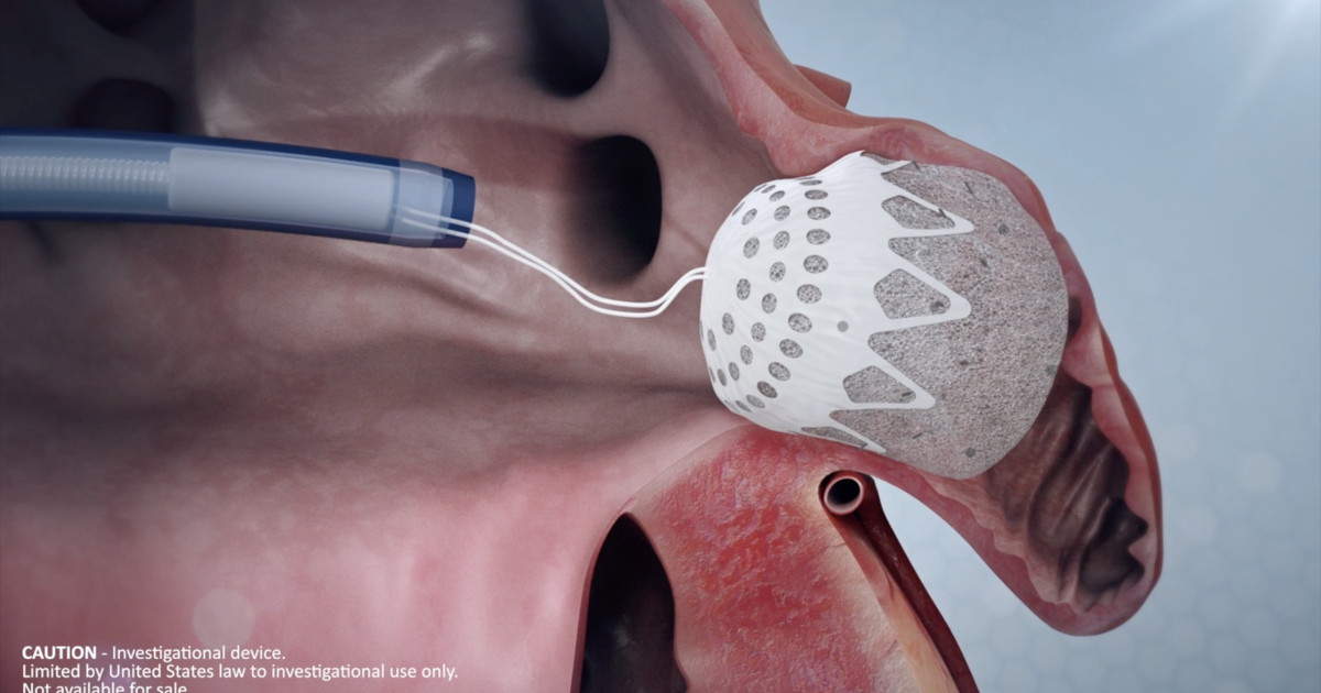 Conformal Medical raises $35M to continue development, research of next ...