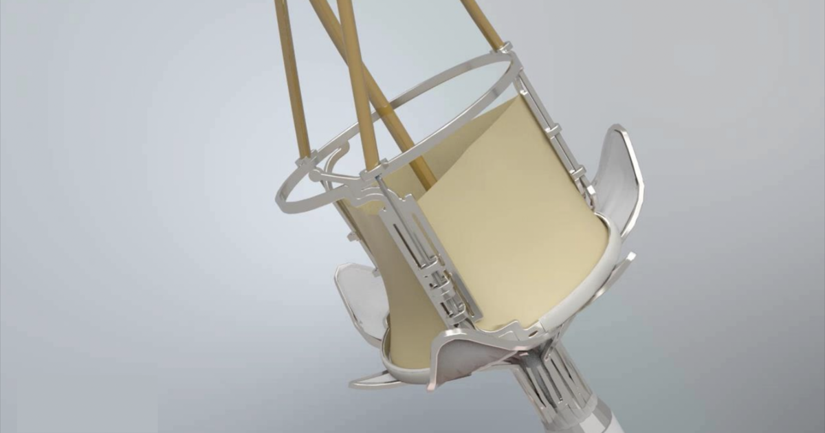 Cardiologists perform world’s first TAVR with new ultra-low profile valve