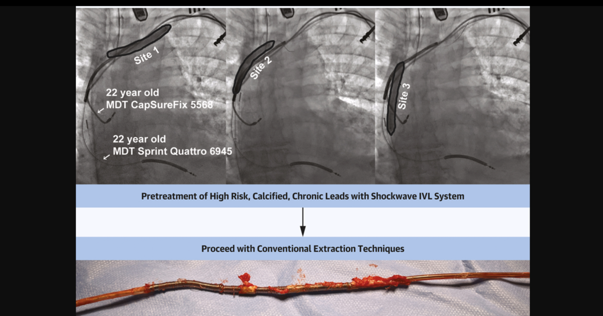 Intravascular lithotripsy helps address the challenges of transvenous ...