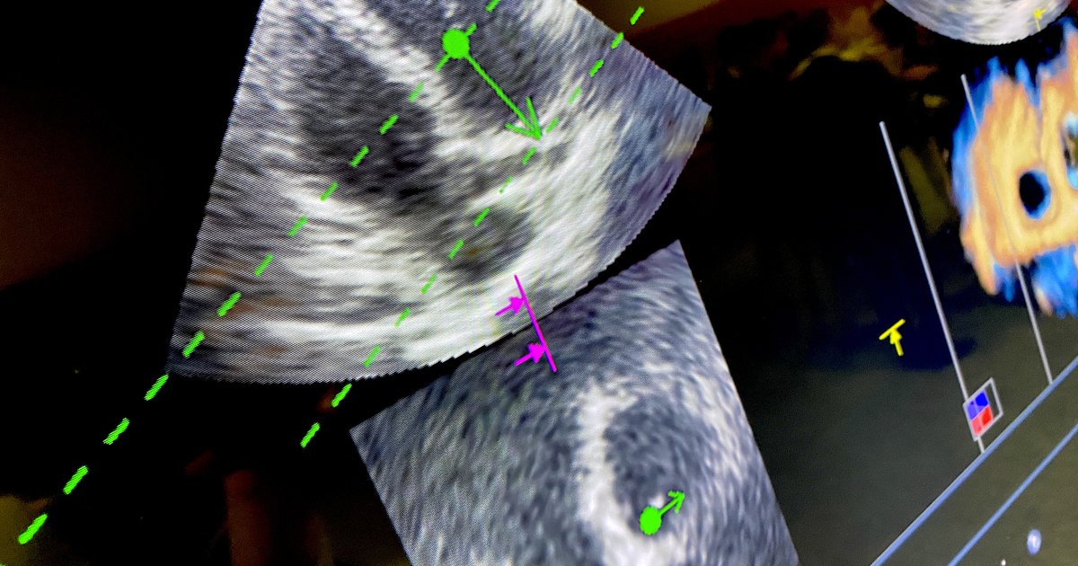 ASE shares new recommendations for evaluating LV diastolic function, HFpEF