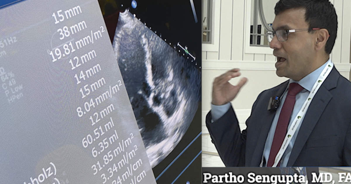 2 key reasons the use of AI in echocardiography is growing