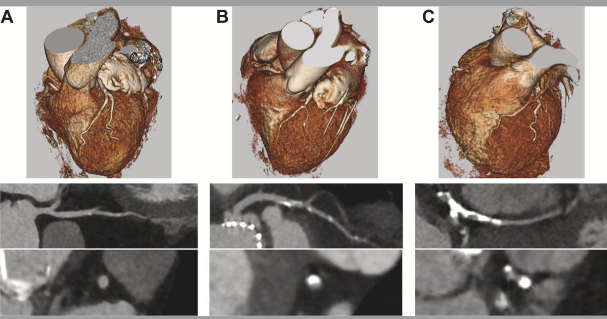 Cardiac CT before TAVR detects CAD with high accuracy, suggesting a ...