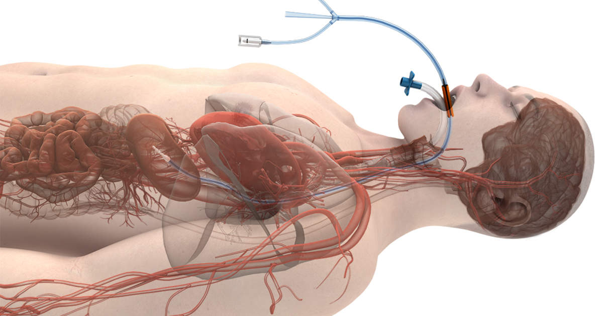 Cooling device now approved by FDA to reduce risk of ablation-related ...