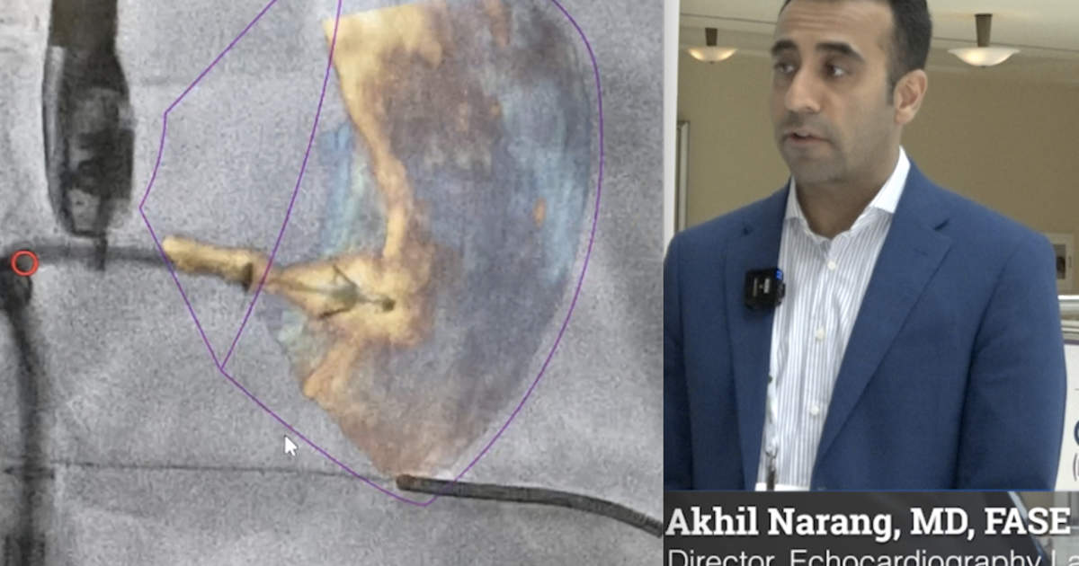The evolving roles of TEE and ICE in structural heart interventions