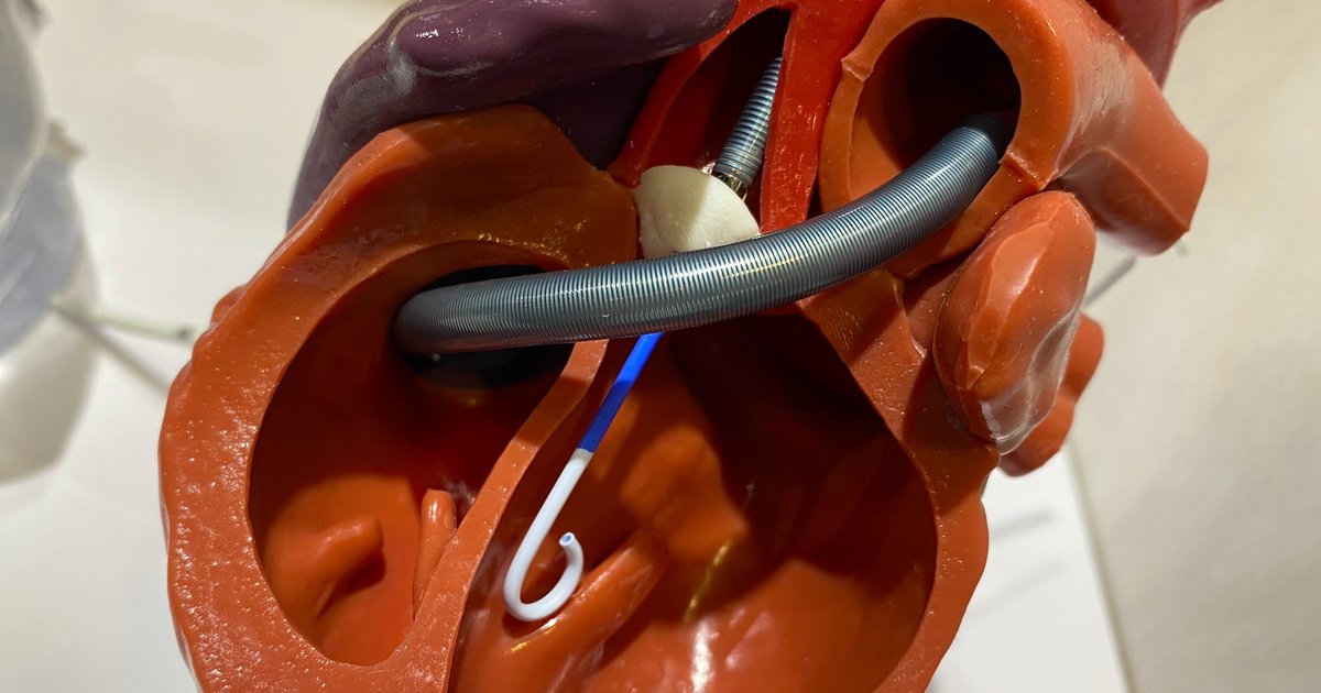 FDA approves J&J MedTech’s Impella heart pumps to treat pediatric patients