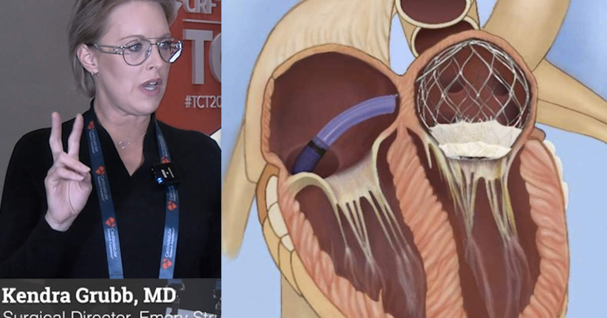 Key trends in transcatheter tricuspid and mitral valve technologies