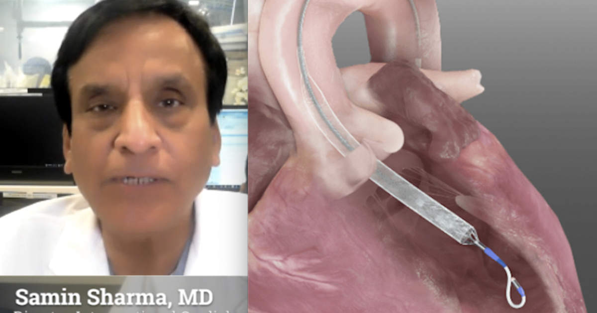 Initial results promising for world's smallest percutaneous heart pump