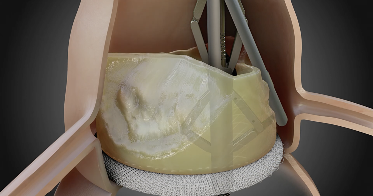 FDA grants new valve-in-valve TAVR offering its breakthrough device ...