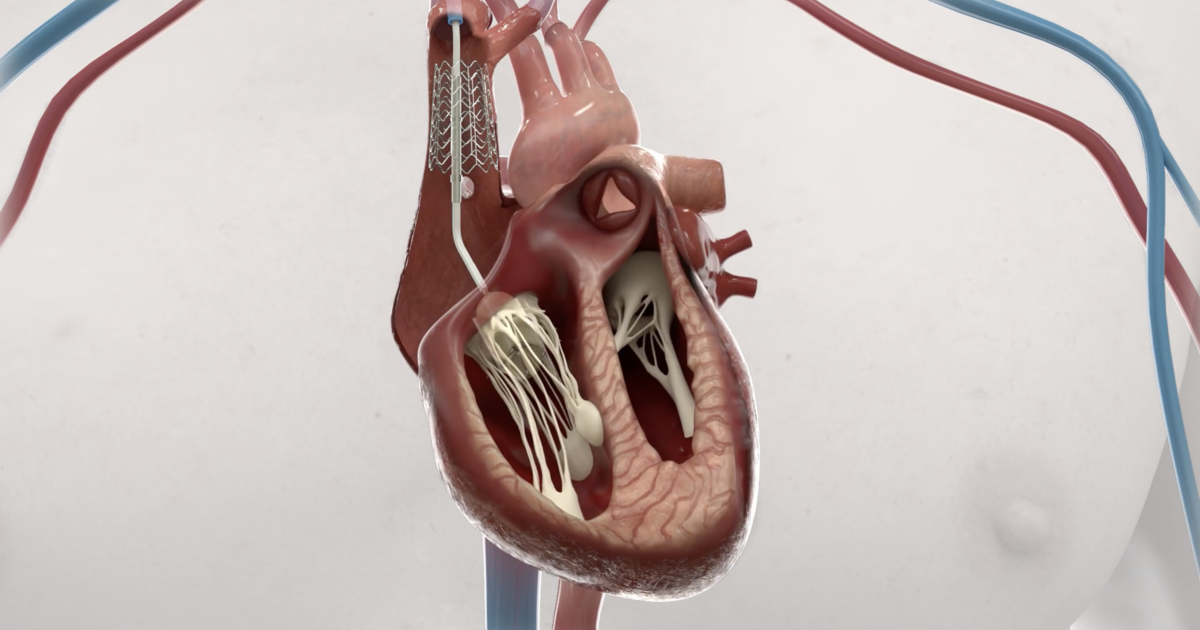 CroíValve kicks off early feasibility study for new TR device, names ...